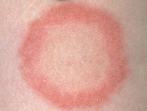 Микоз грибок: причины, симптомы, лечение, микоз у детей, народная медицина